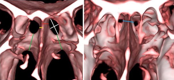Evaluation of the surgical anatomy of sphenoid ostium with 3D computed ...