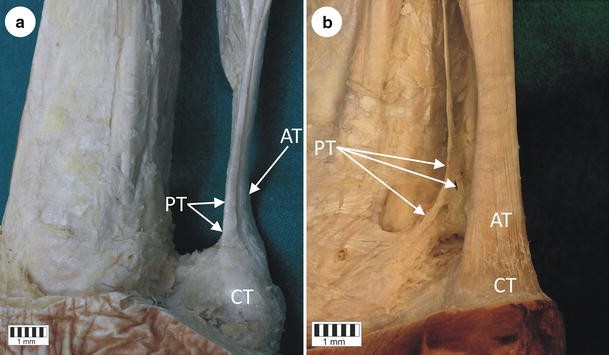 Anatomic study suggests that the morphology of the plantaris tendon may ...