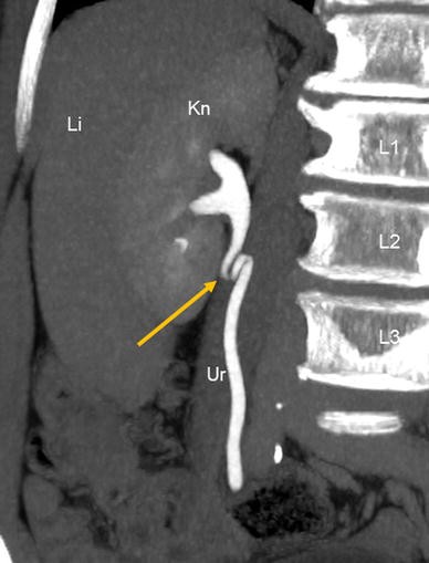 Kinking of the upper ureter in CT urography: anatomic and clinical ...