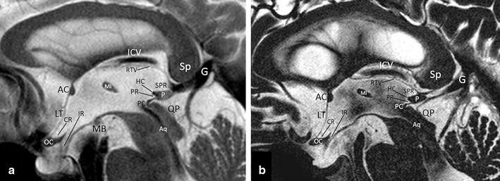 The suprapineal recess of the third ventricle: an anatomic study with ...