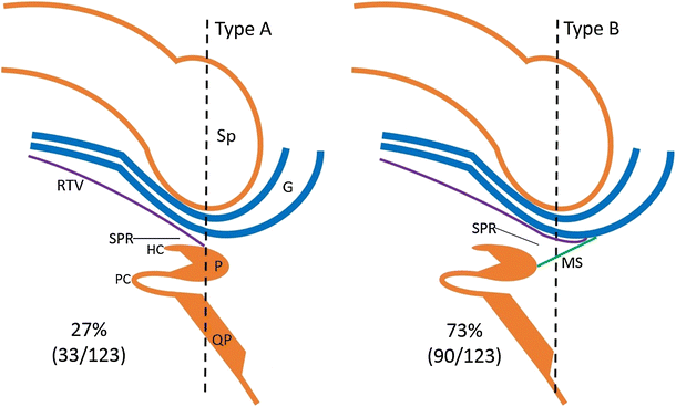 The suprapineal recess of the third ventricle: an anatomic study with ...