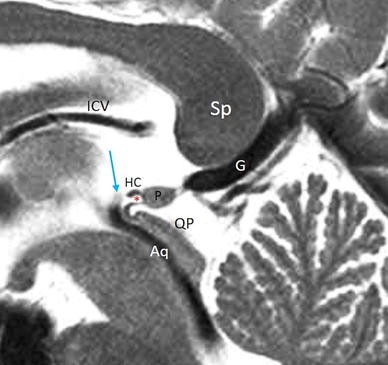 The suprapineal recess of the third ventricle: an anatomic study with ...
