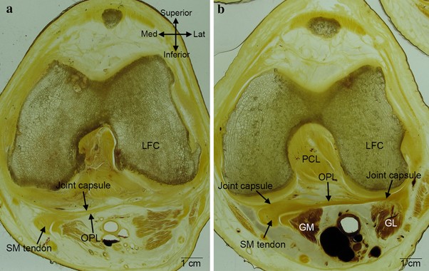 The oblique popliteal ligament: an anatomic and MRI investigation ...