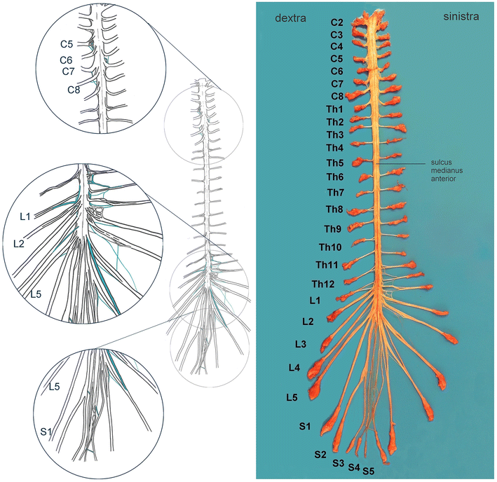 Intraspinal intradural variations of nerve roots | SpringerLink