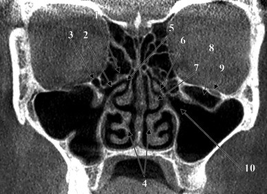 Rare anatomic variation: true bifid inferior turbinate | SpringerLink