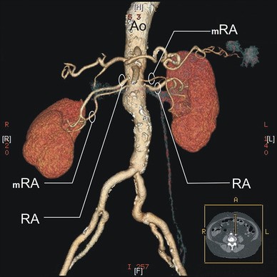 Does the type of renal artery anatomic variant determine the diameter ...