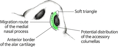 A congenital accessory skin appendage of the nasal columella and ...