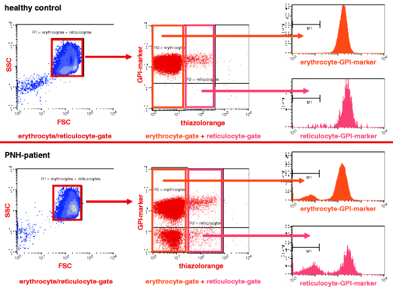 Paroxysmal nocturnal hemoglobinuria (PNH): higher sensitivity and ...