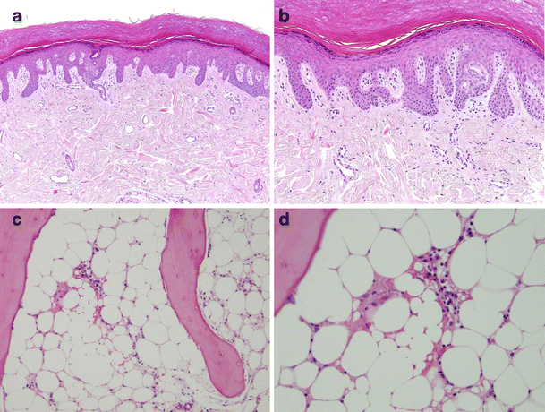 Acute vesiculobullous hand dermatitis and anagen effluvium in Ganoderma ...