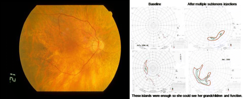 Autoimmune retinopathy: A review and summary | SpringerLink