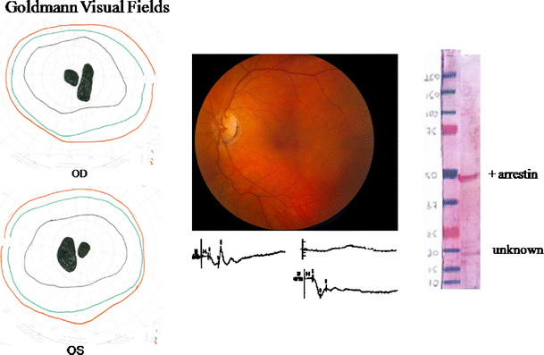 Autoimmune retinopathy: A review and summary | SpringerLink