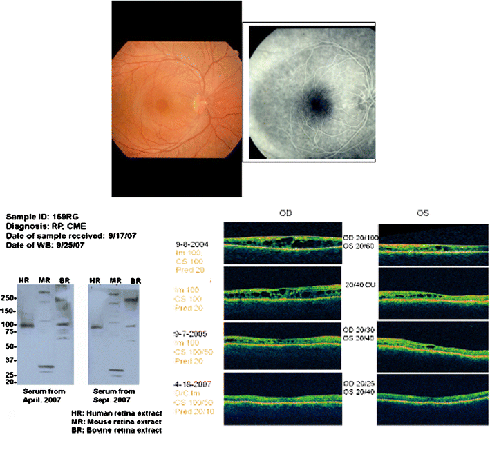 Autoimmune retinopathy: A review and summary | SpringerLink