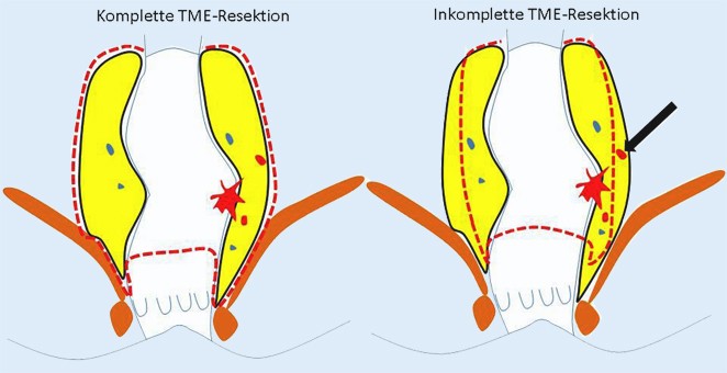 Pathologische Aufarbeitung von Rektumkarzinomen mit partieller/totaler ...