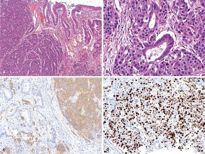 Gastrointestinale gemischte adenoneuroendokrine Karzinome | SpringerLink
