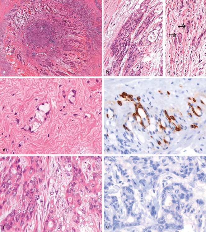 Gastrointestinale gemischte adenoneuroendokrine Karzinome | SpringerLink