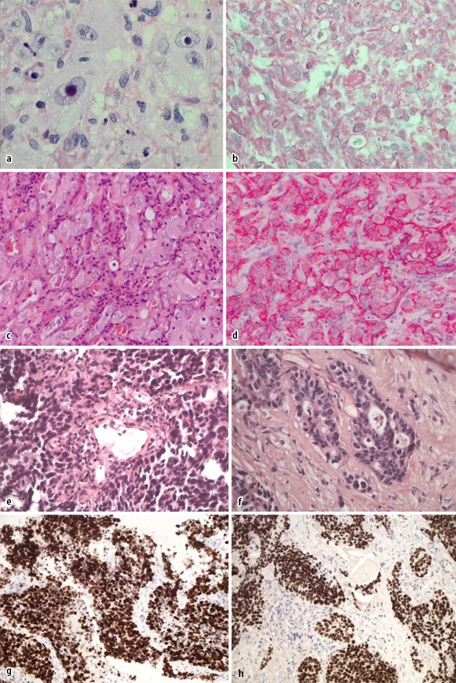 Karzinome der Lunge | SpringerLink