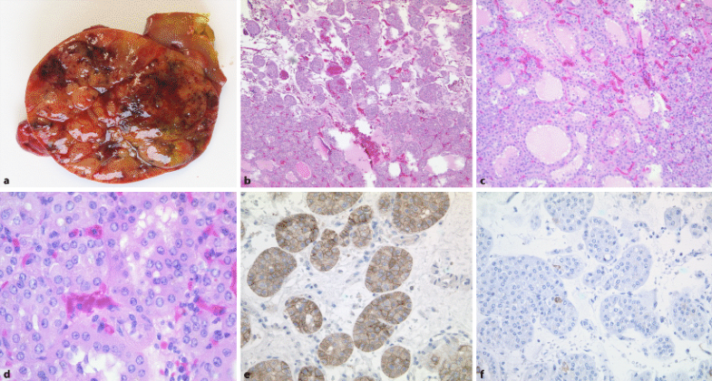 Onkozytom versus chromophobes Nierenkarzinom | SpringerLink
