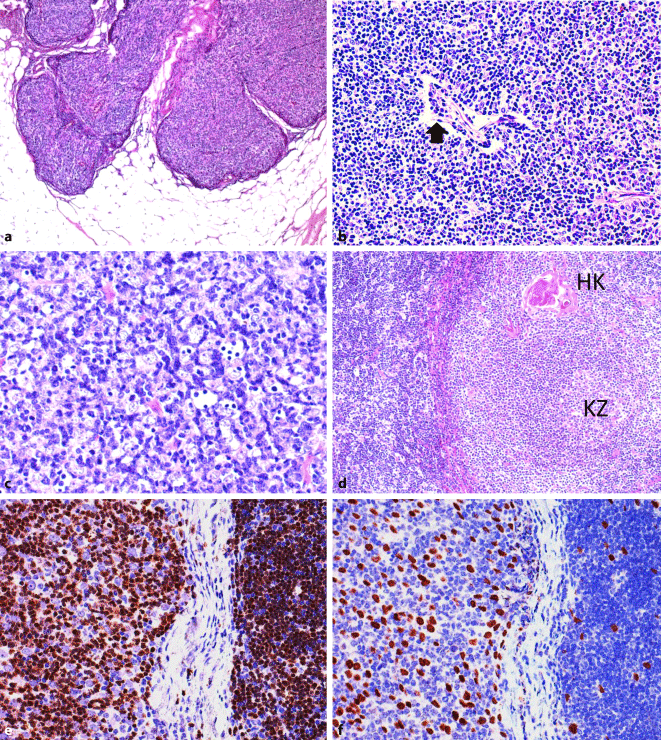Thymome | SpringerLink