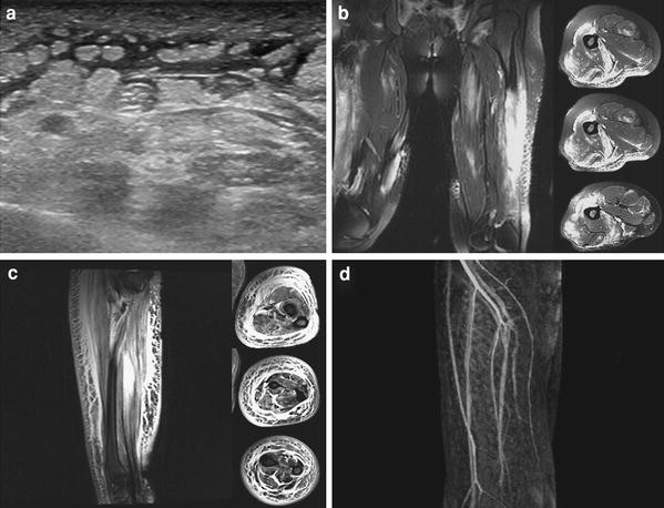 Acute dermatomyositis associated with generalized subcutaneous edema ...