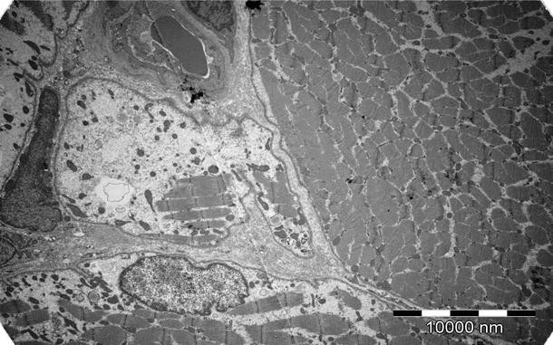 Inclusion body myositis associated with Sjögren’s syndrome | SpringerLink