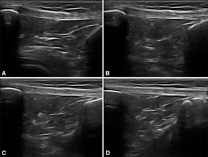 Sonographic characterization of Hoffa’s fat pad. A pilot study ...