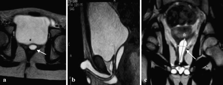 A boy with acute urinary retention: a Mullerian duct remnant (2006: 3b ...