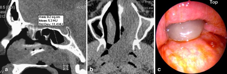 Imaging of nasopharyngeal cysts and bursae | SpringerLink