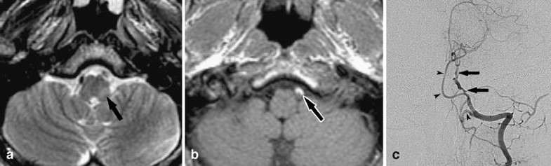 Dissection of the V4 segment of the vertebral artery: clinicoradiologic ...