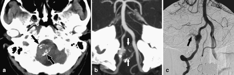 Dissection of the V4 segment of the vertebral artery: clinicoradiologic ...