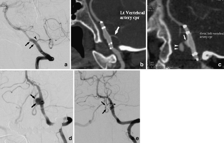 Dissection of the V4 segment of the vertebral artery: clinicoradiologic ...