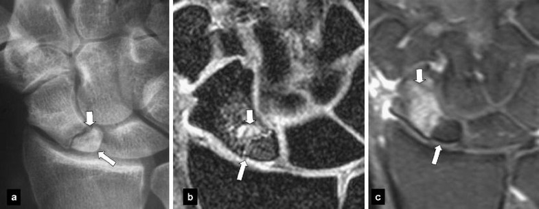 The role of MR imaging in scaphoid disorders | SpringerLink