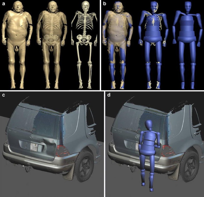 Virtual autopsy using imaging: bridging radiologic and forensic ...