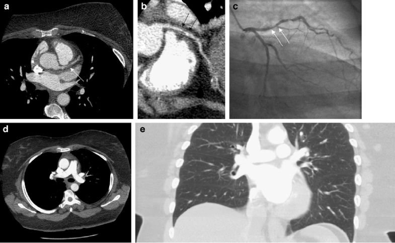 ECG-gated chest CT angiography with 64-MDCT and tri-phasic IV contrast ...