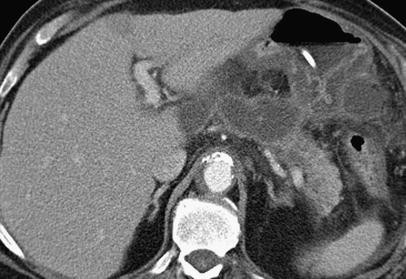 CT findings of walled-off pancreatic necrosis (WOPN): differentiation ...