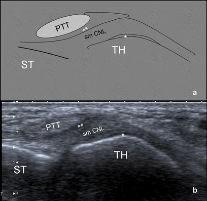 Ultrasound assessment of the spring ligament complex | SpringerLink