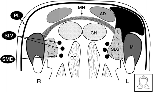 Plunging ranulas: high-resolution ultrasound for diagnosis and surgical ...