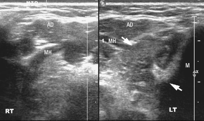 Plunging ranulas: high-resolution ultrasound for diagnosis and surgical ...