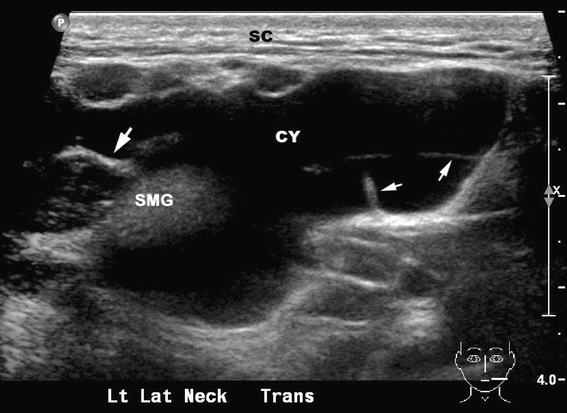 Plunging ranulas: high-resolution ultrasound for diagnosis and surgical ...