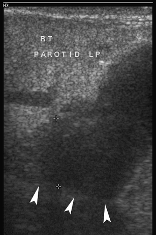 Plunging ranulas: high-resolution ultrasound for diagnosis and surgical ...