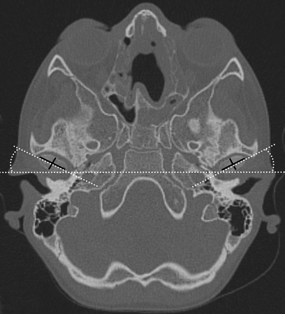 Size, shape and age-related changes of the mandibular condyle during ...