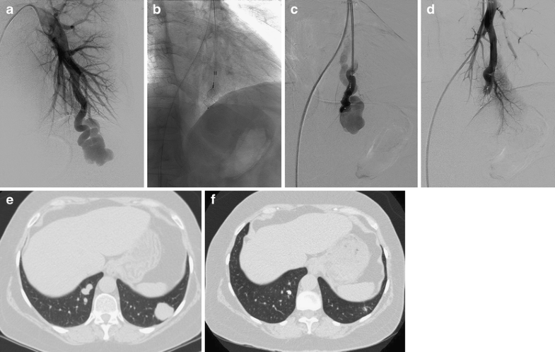 Embolization of pulmonary arteriovenous malformations using the ...