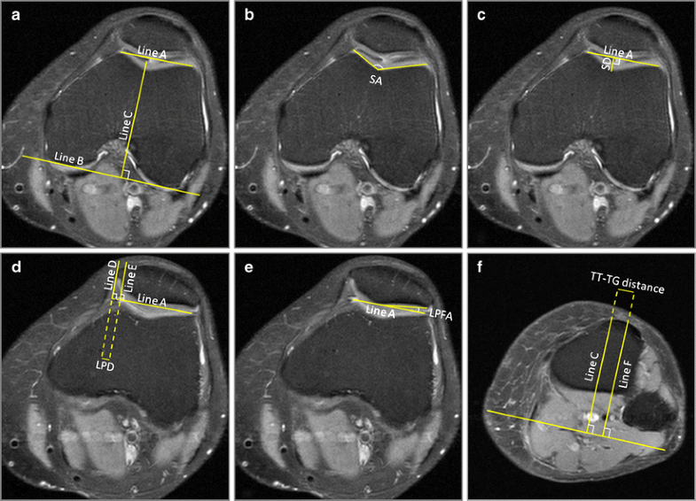 Knee joint anterior malalignment and patellofemoral osteoarthritis: an ...