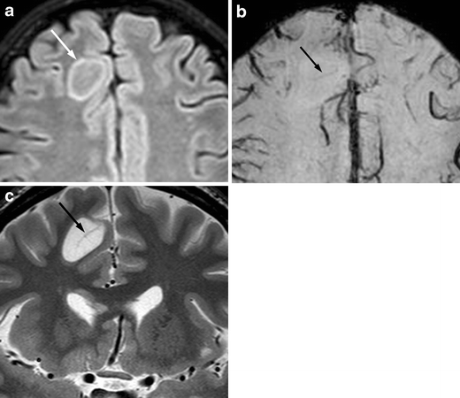 The “central vein sign”: is there a place for susceptibility weighted ...