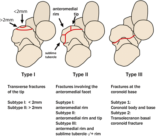 Traumatic instability of the elbow - anatomy, pathomechanisms and ...
