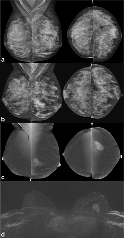 Contrast-enhanced spectral mammography versus MRI: Initial results in ...