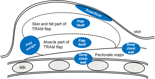 Local recurrence of breast cancer in reconstructed breasts using TRAM ...