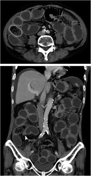 Imaging differentiation of phytobezoar and small-bowel faeces: CT ...