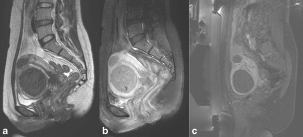 MRI predictors of clinical success in MR-guided focused ultrasound ...