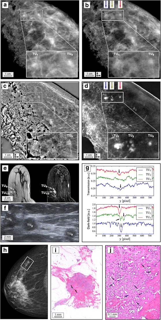 Improved visualization of breast cancer features in multifocal ...