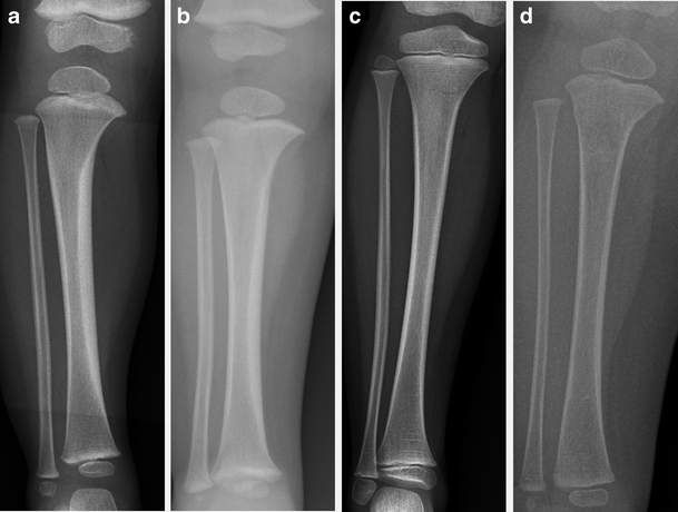 Tibial bowing in children - what is normal? a radiographic study ...